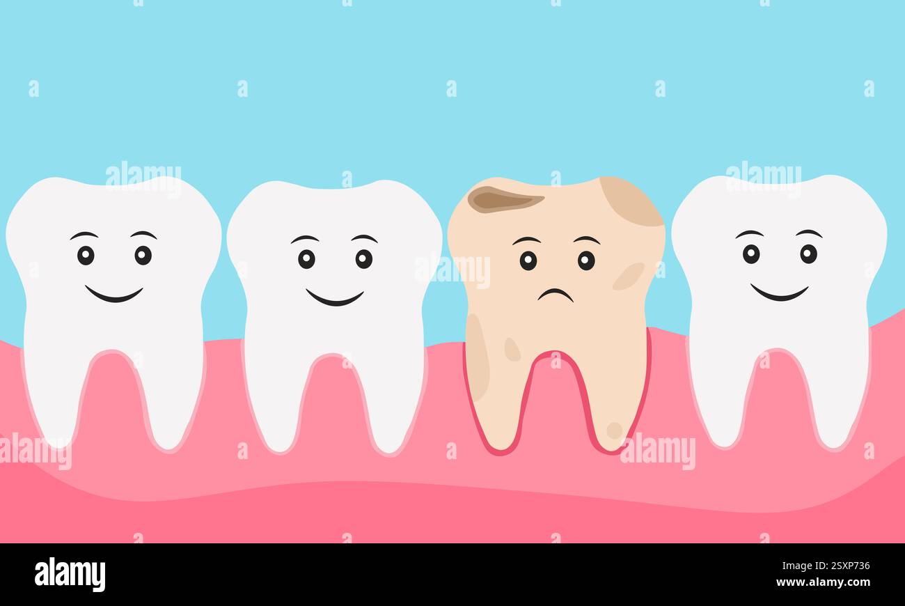 Tooth decay. Plaque teeth. Dental caries. Tooth hygiene. Oral dental ...