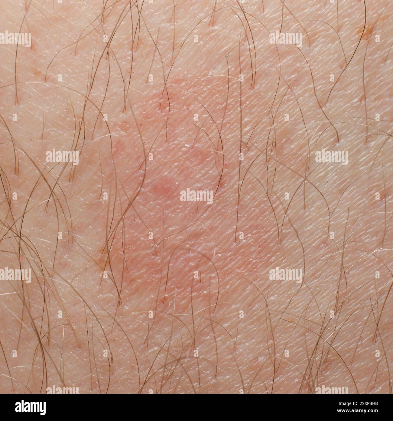 Flaky skin rash hi-res stock photography and images - Alamy