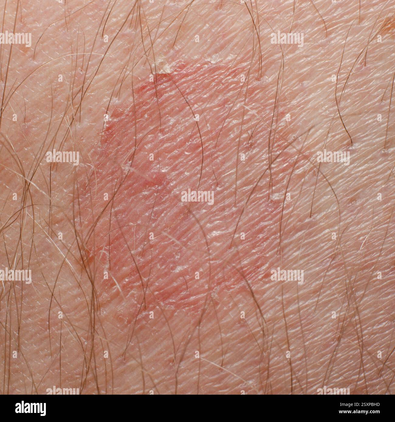 Flaky skin rash hi-res stock photography and images - Alamy