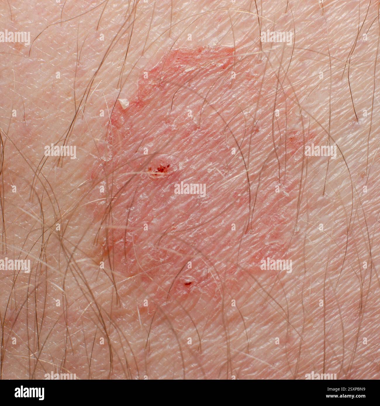 Red Skin Rash Close-up Macro View Stock Photo - Alamy