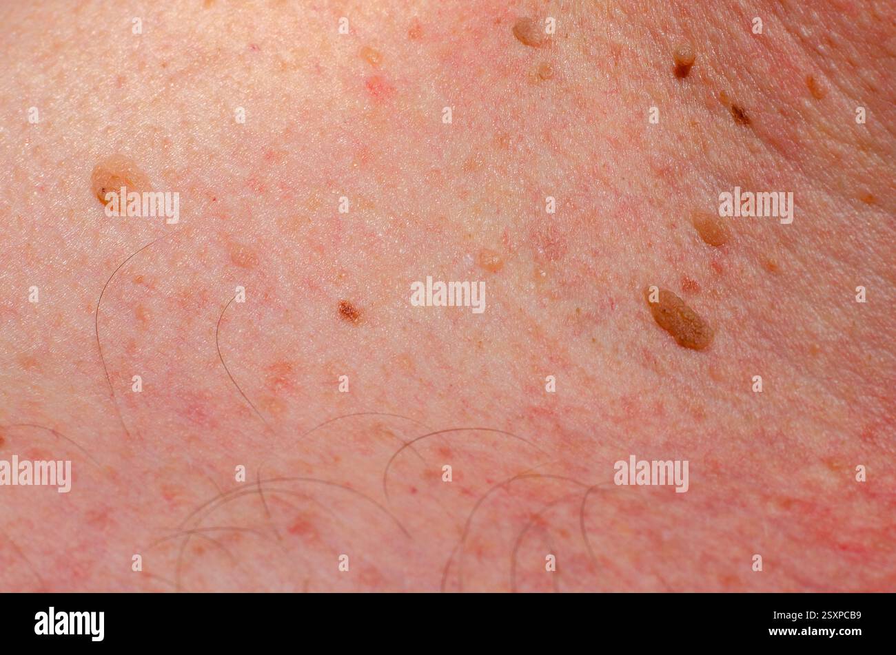 Human skin cancer close up Stock Photo - Alamy
