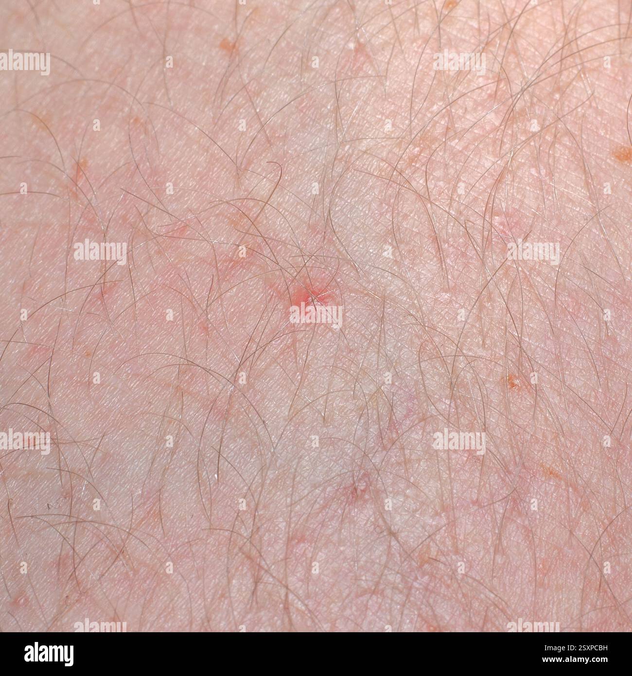 Human skin closeup with red blemish Stock Photo - Alamy