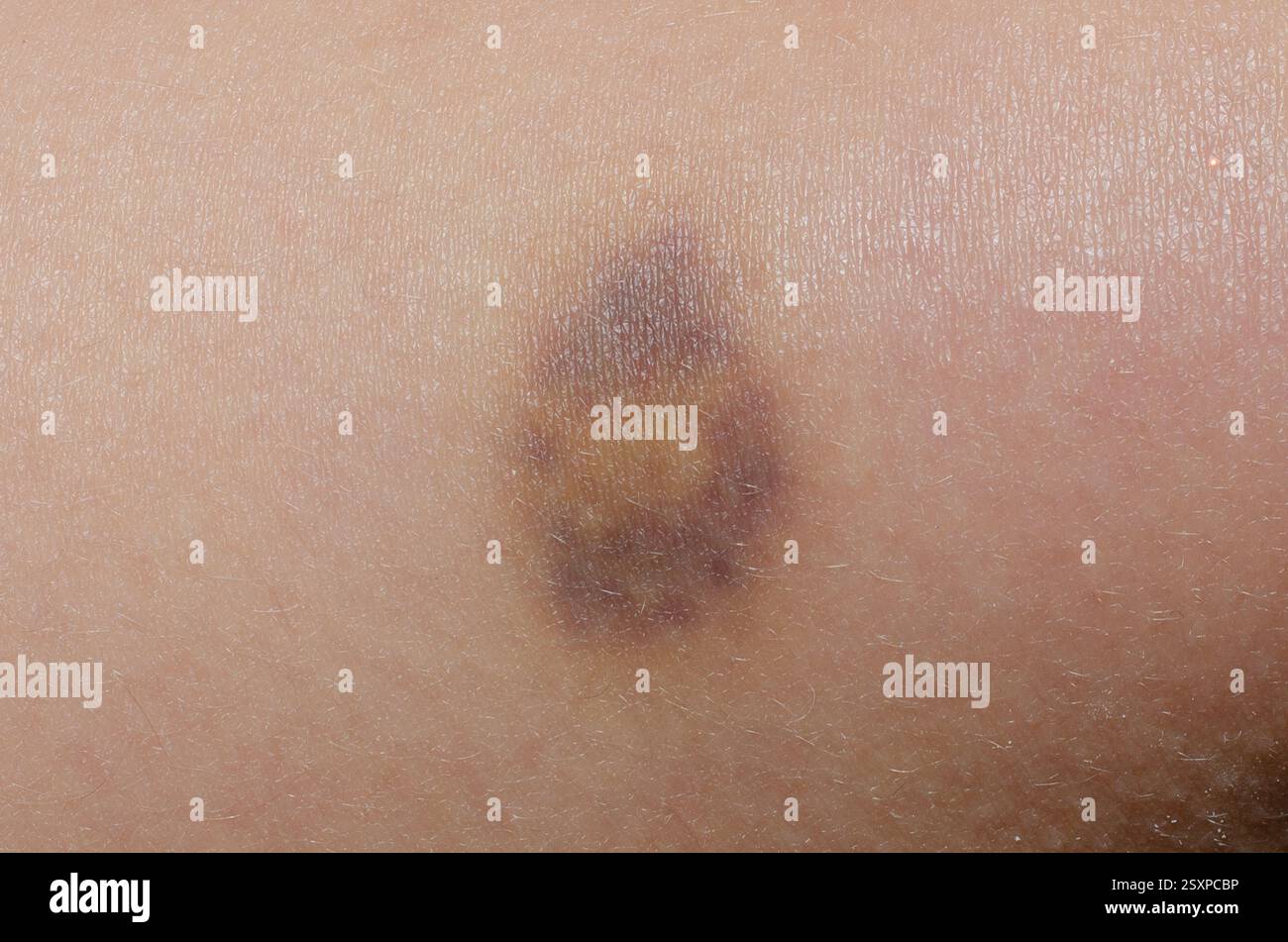 Skin bruise texture hi-res stock photography and images - Alamy