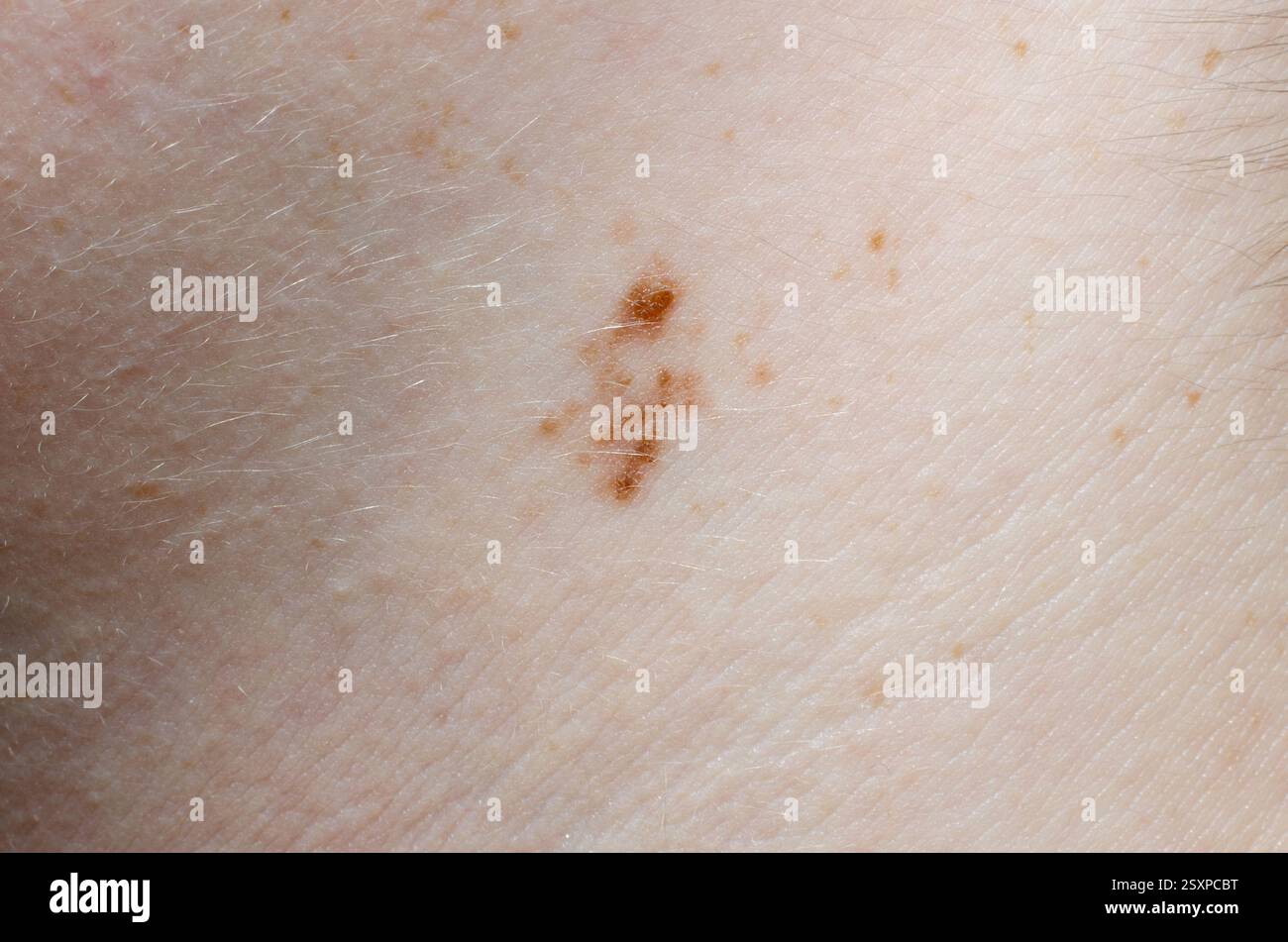 Close-up of a Mole on Human Skin Stock Photo - Alamy