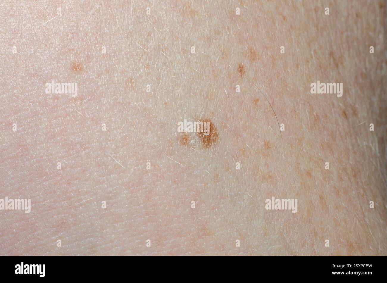 Nevus on human skin close-up Stock Photo - Alamy