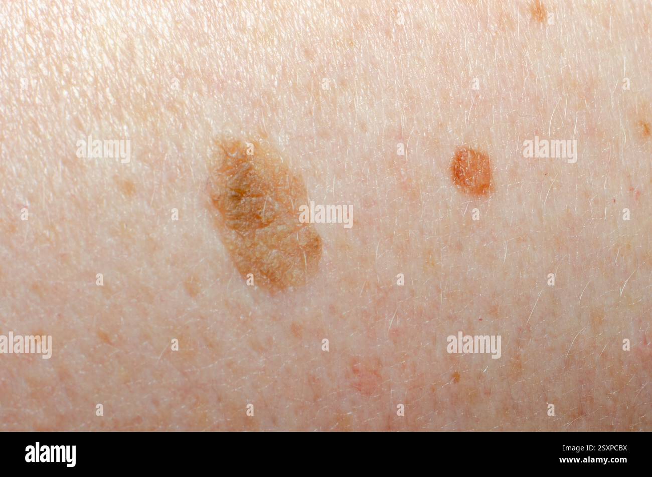 Nevus on human skin close-up Stock Photo - Alamy