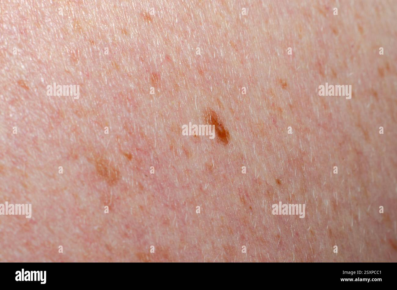 Nevus on human skin close-up Stock Photo - Alamy