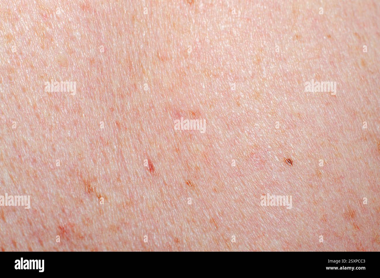 Nevus on human skin close-up Stock Photo - Alamy