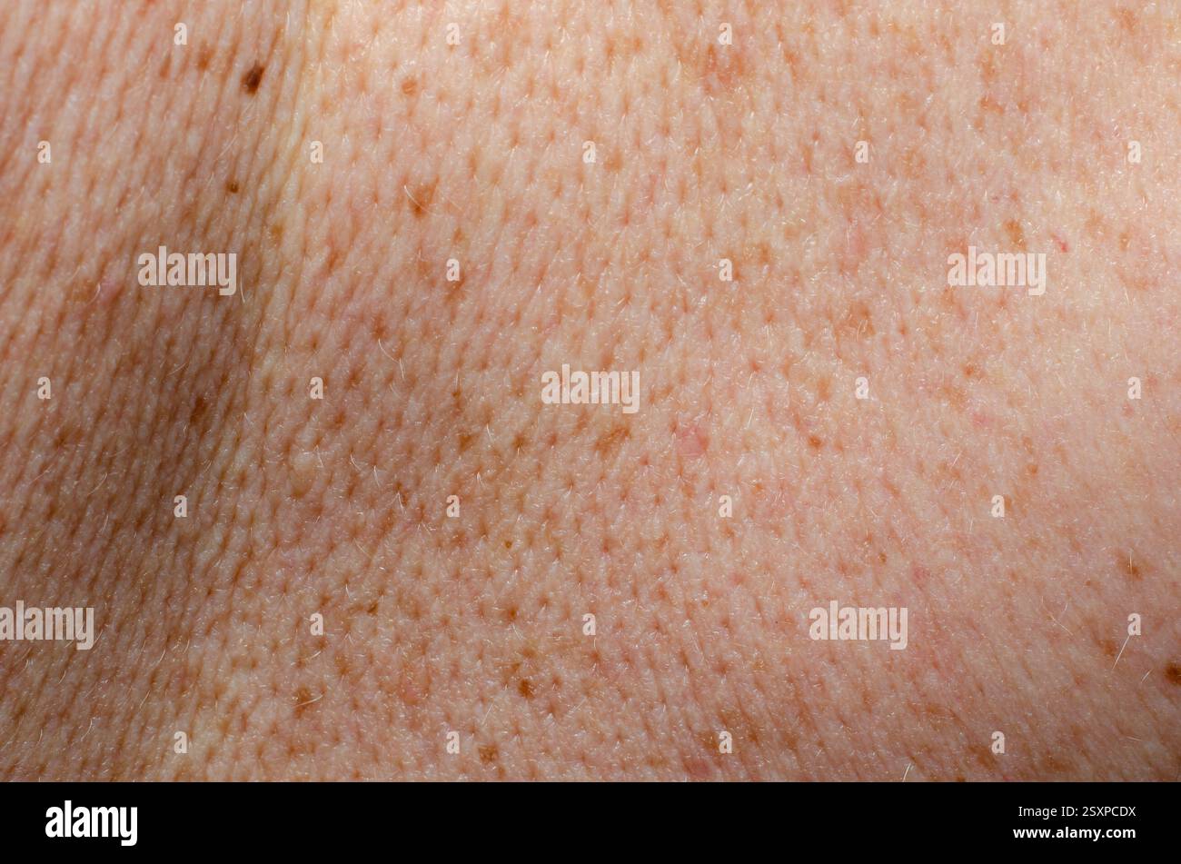Nevus on human skin close-up Stock Photo - Alamy