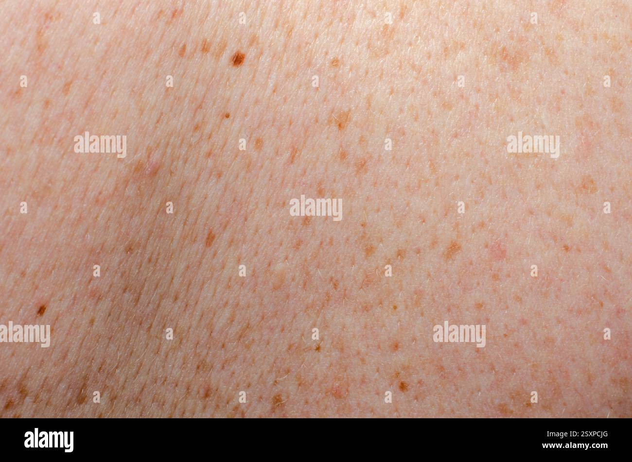 Nevus on human skin close-up Stock Photo - Alamy