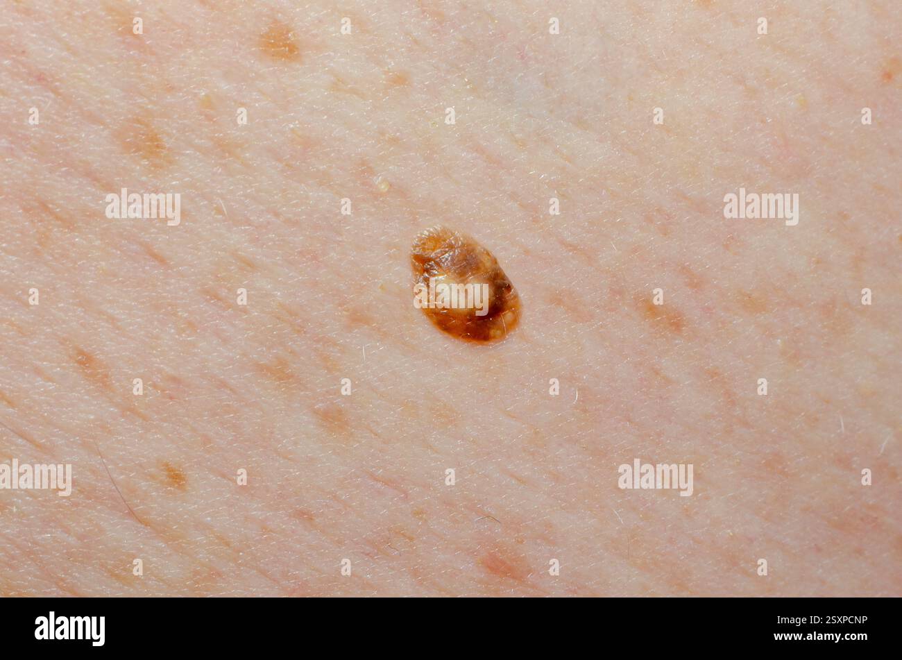 Nevus on human skin close-up Stock Photo - Alamy