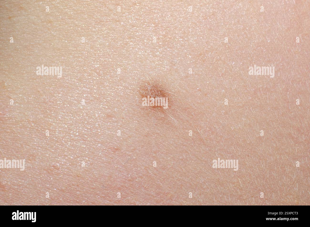 Nevus on human skin close-up Stock Photo - Alamy