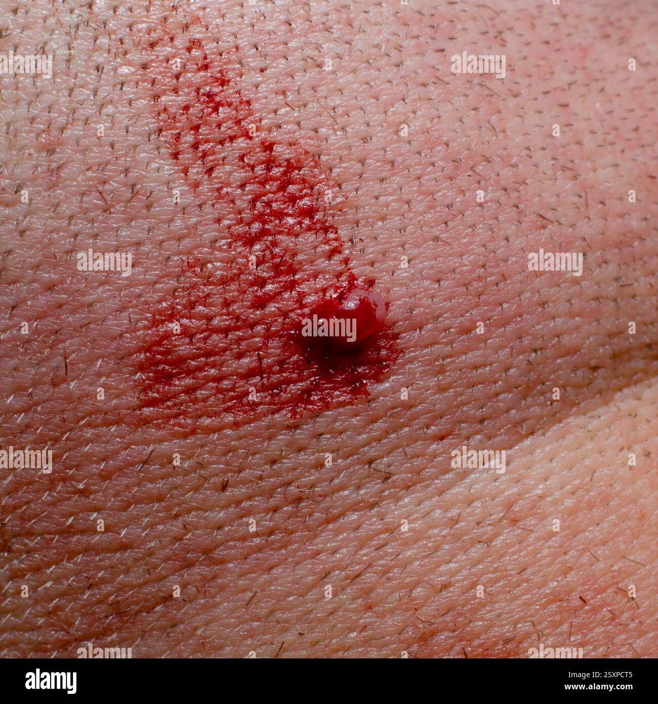 Damaged nevus on human skin with blood Stock Photo - Alamy