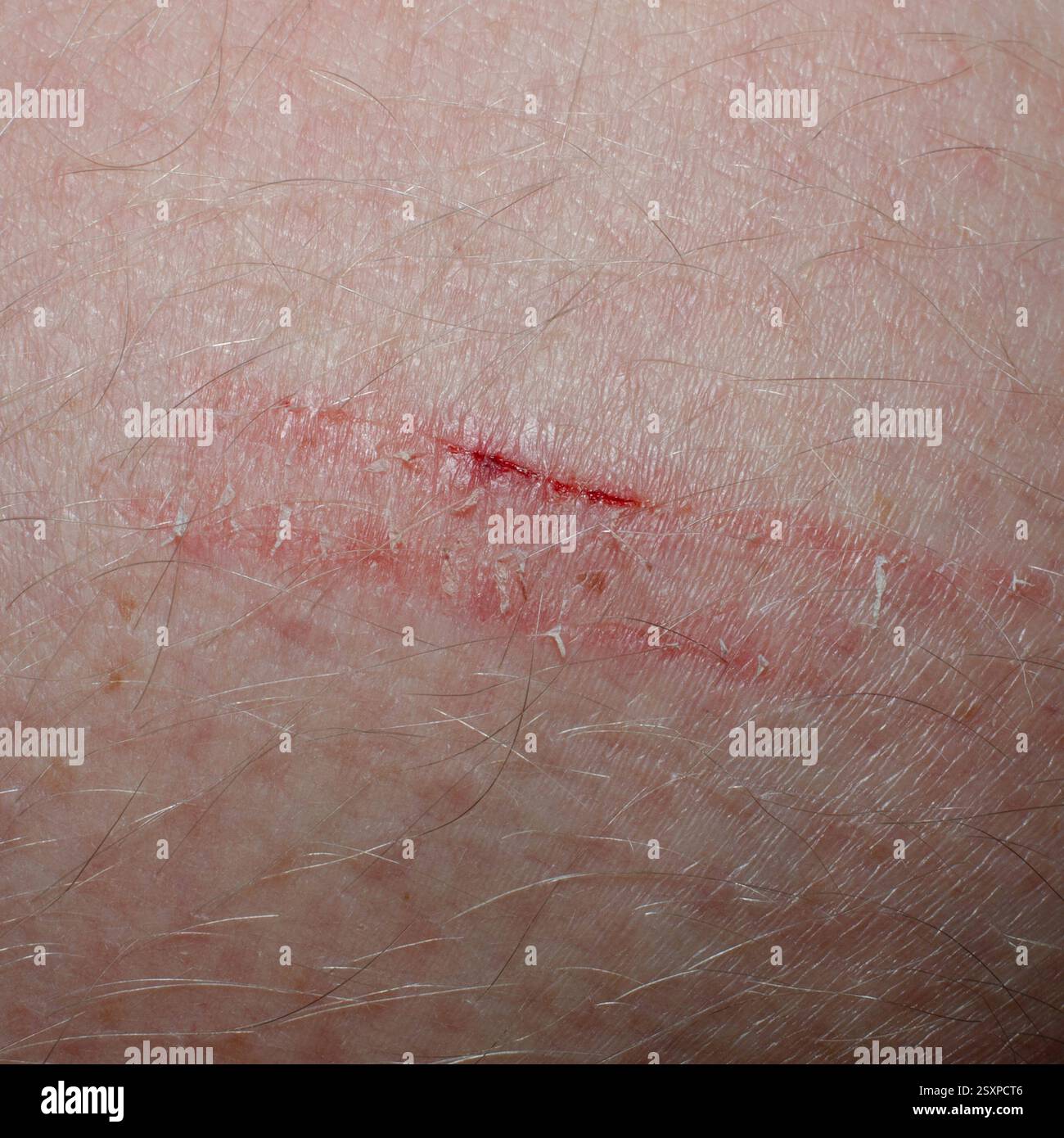 Scratch on human skin hi-res stock photography and images - Alamy