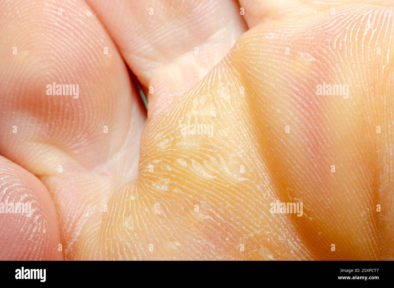 Calluses on the human foot fungus and skin damage Stock Photo - Alamy