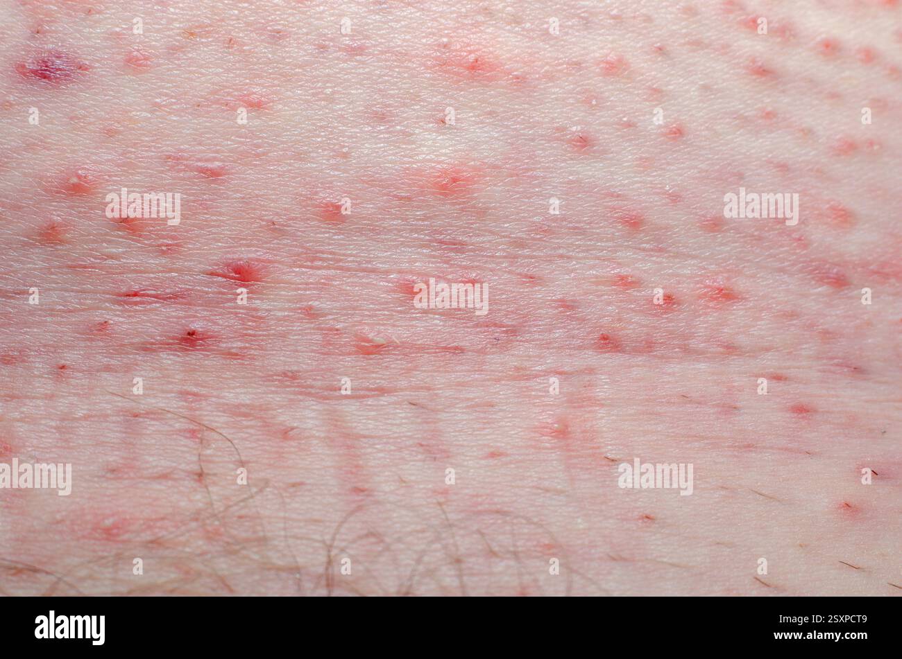 Human body wound. Skin irritation after shaving, pimples and acne and ...