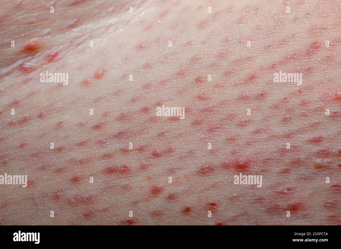 Human body wound. Skin irritation after shaving, pimples and acne and ...