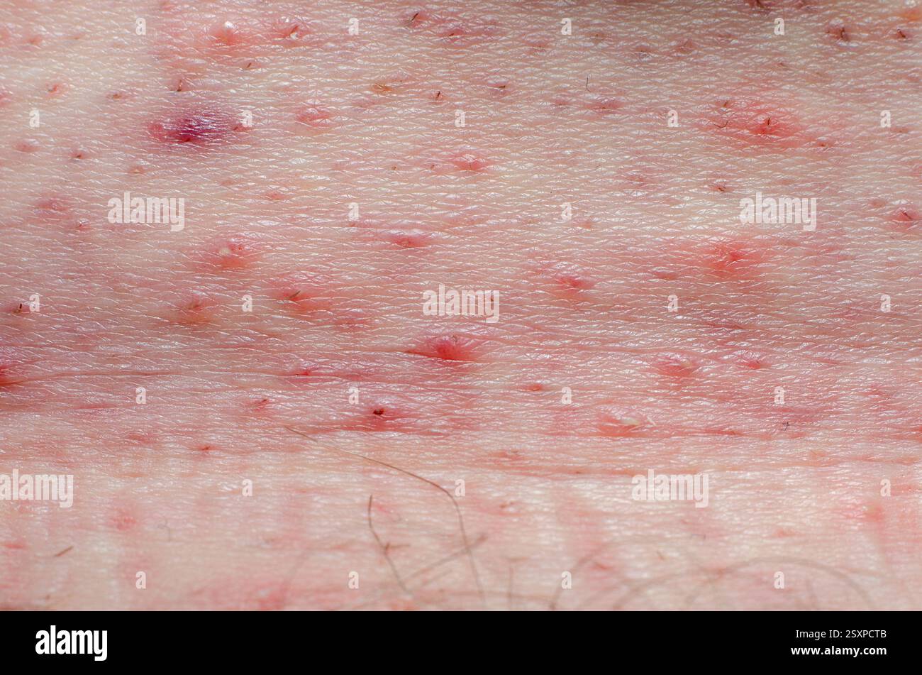 Human body wound. Skin irritation after shaving, pimples and acne and ...