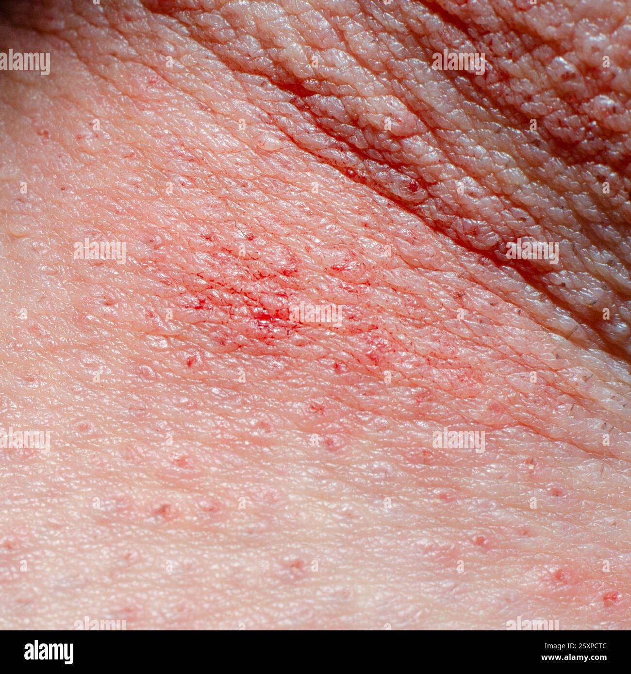 Human body wound. Skin irritation after shaving, pimples and acne and ...