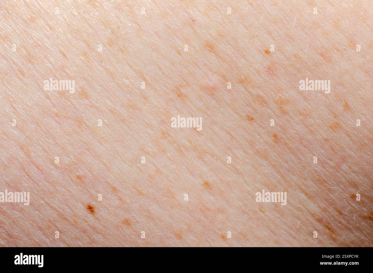 Moles on the skin or pigment spots with nevi Stock Photo - Alamy
