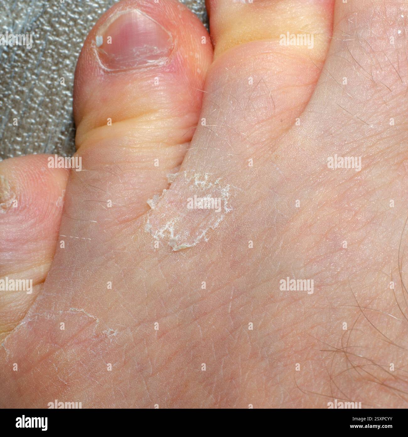 Human body wound. Skin irritation after shaving, pimples and acne and ...