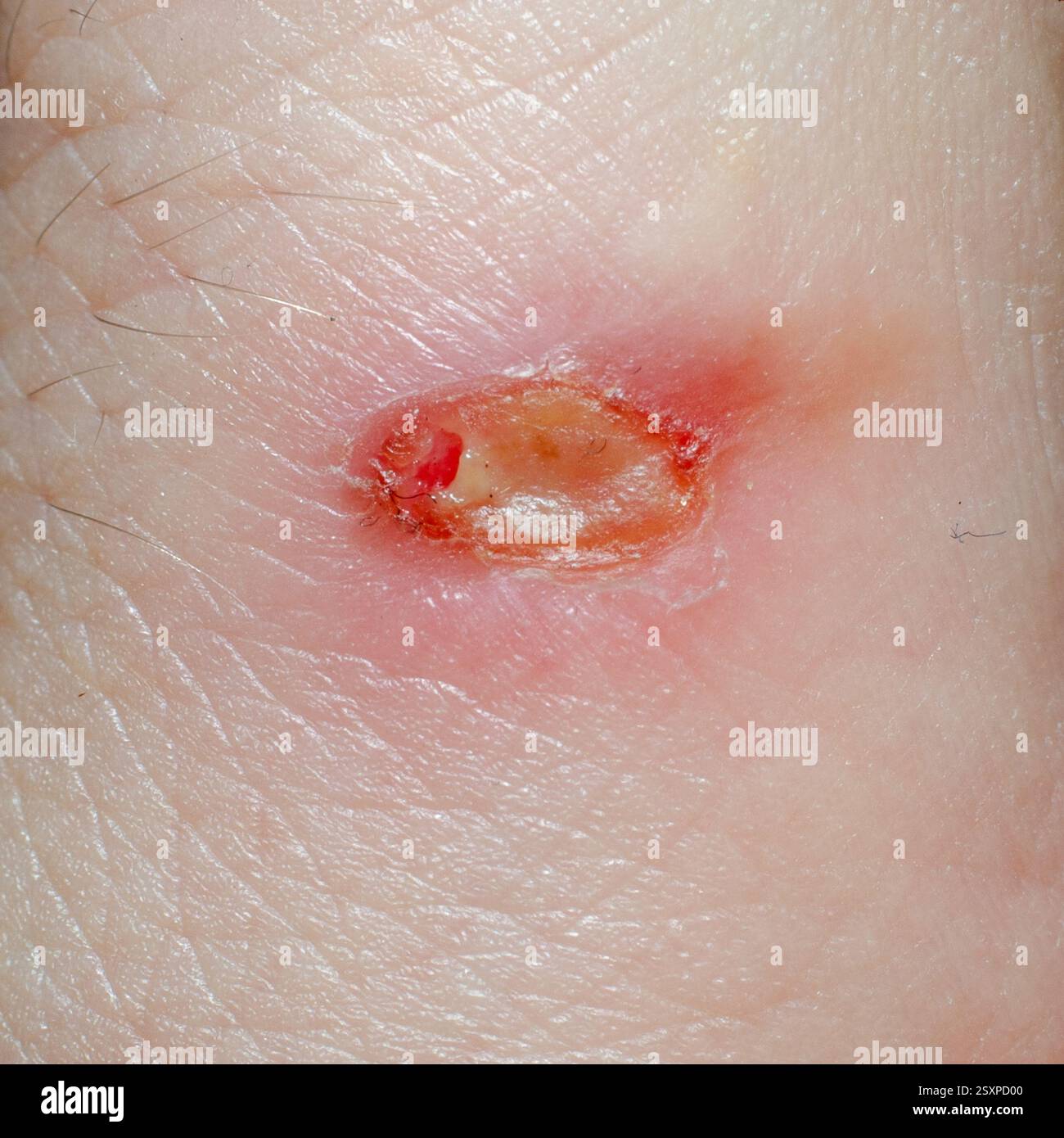 Human body wound. Skin irritation after shaving, pimples and acne and ...