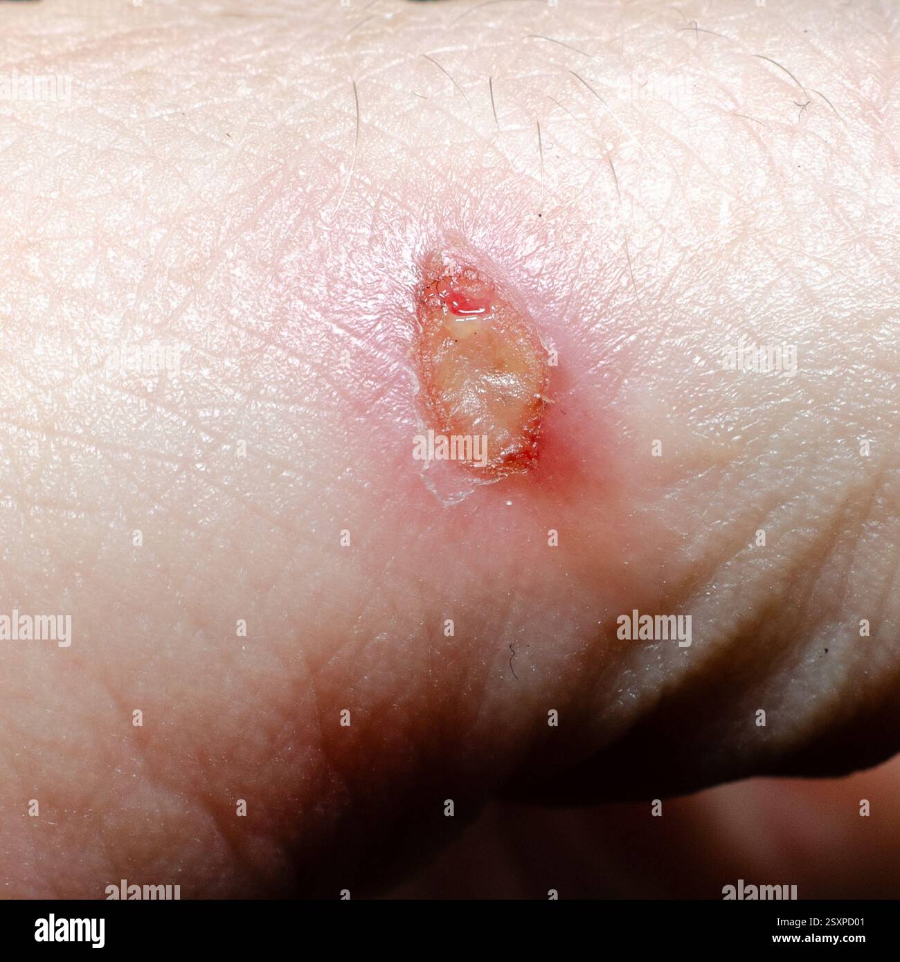 Human body wound. Skin irritation after shaving, pimples and acne and ...