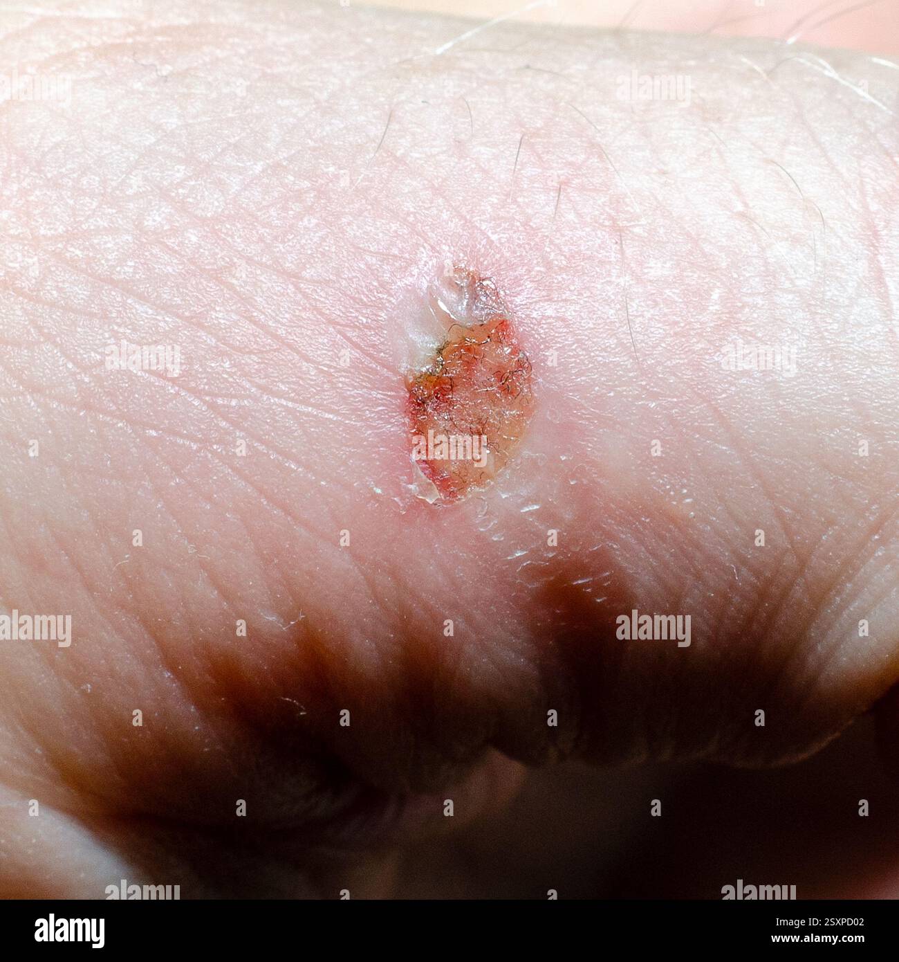 Human body wound. Skin irritation after shaving, pimples and acne and ...