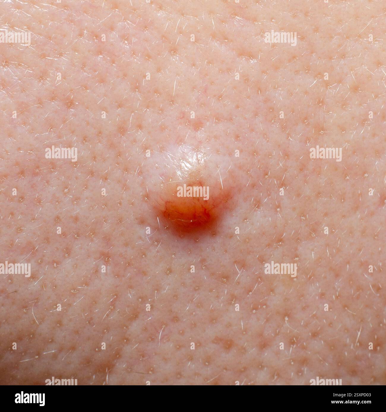 A large mole or papilloma on the head of an adult Stock Photo - Alamy