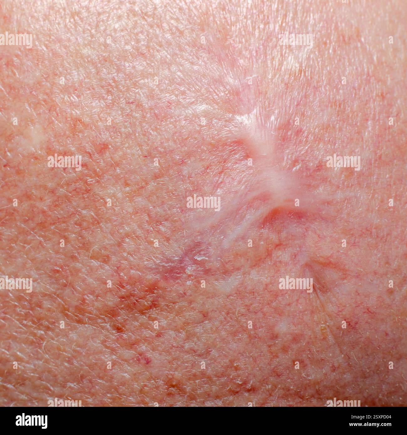 scar from skin cancer on scalp of an adult Stock Photo - Alamy