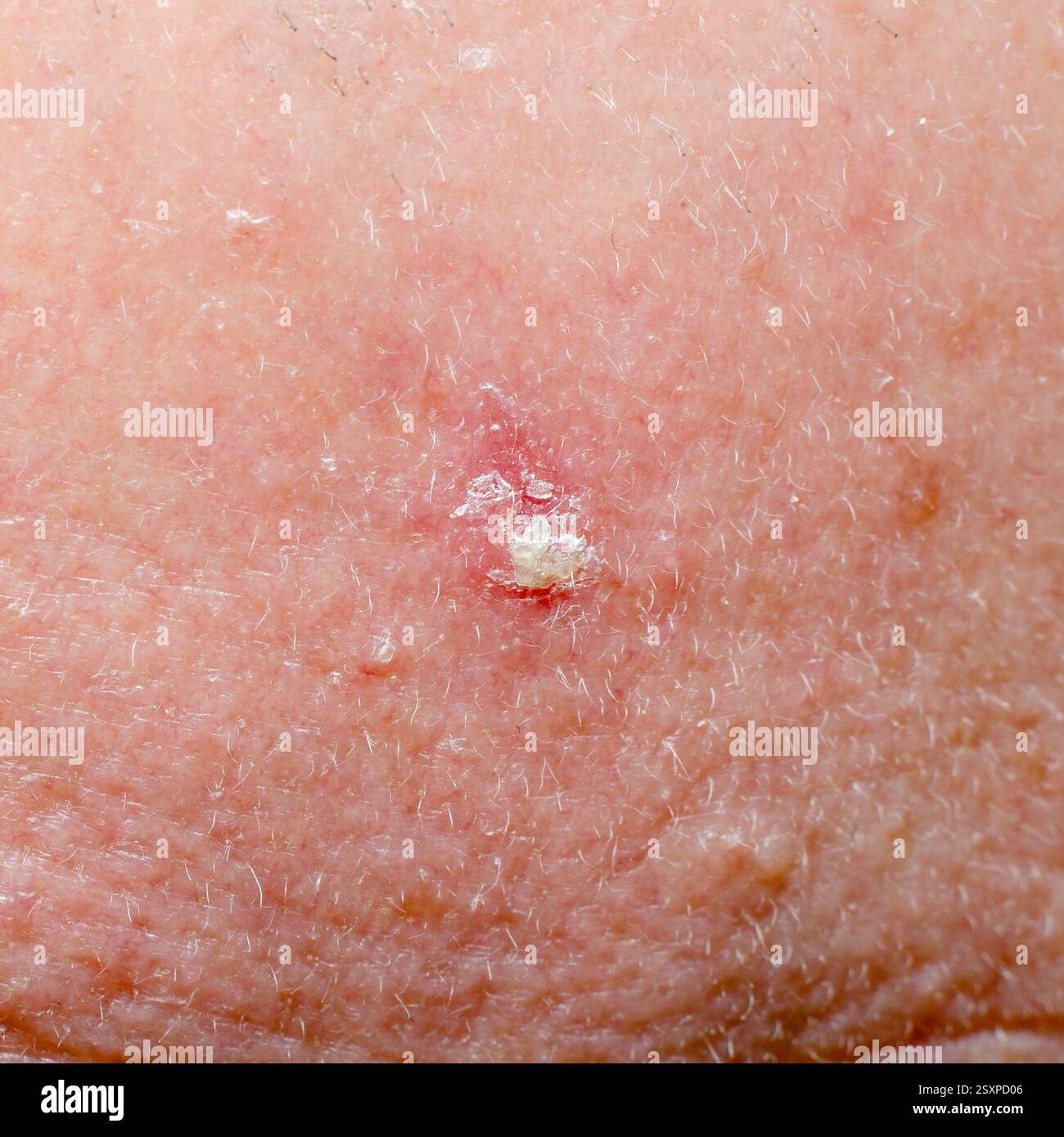 Actinic keratosis or basal cell carcinoma on the scalp of an adult ...