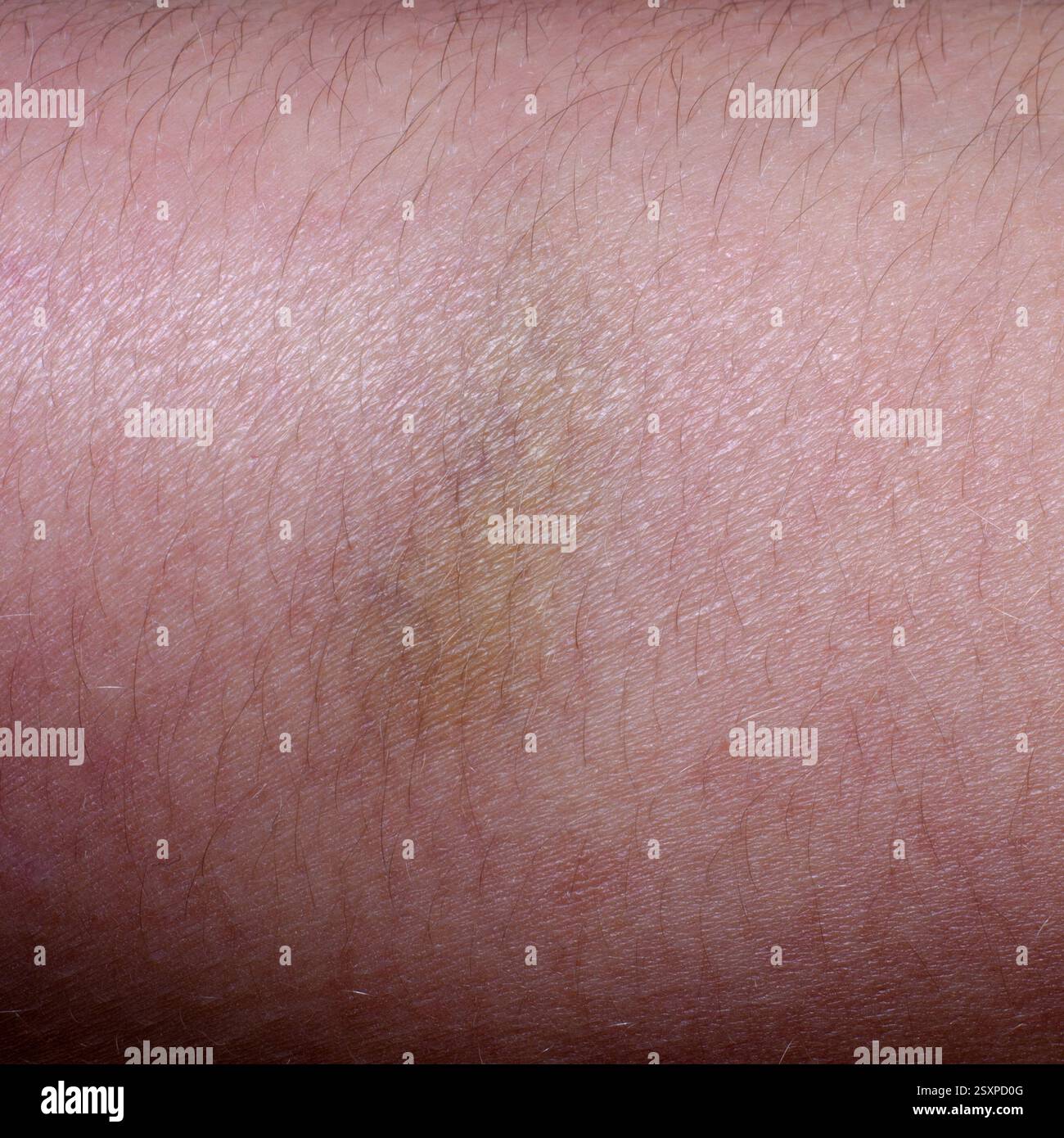 Bruise at the site of a bruise on a child's skin hand close-up Stock ...
