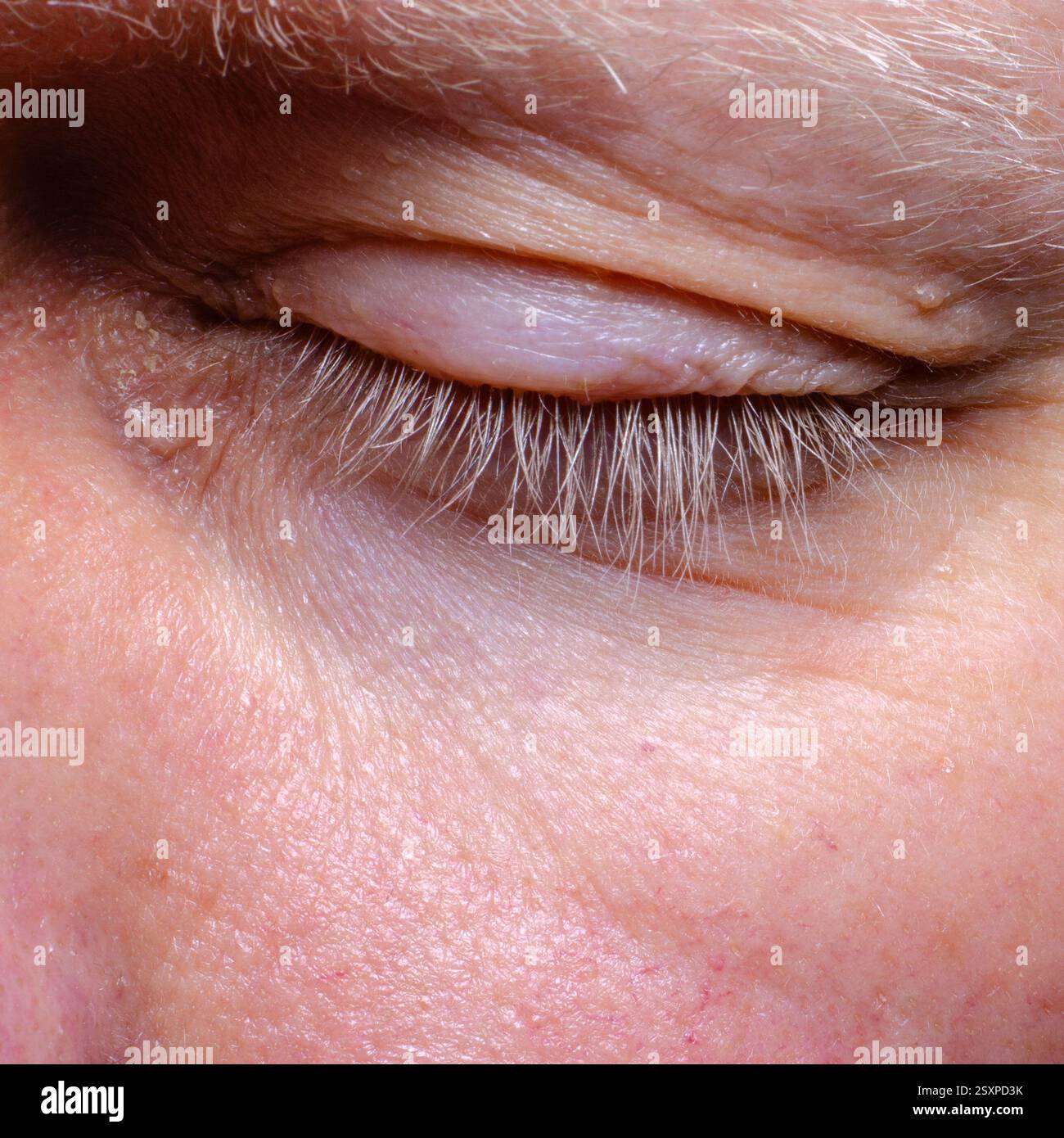Basal cell papilloma hi-res stock photography and images - Alamy