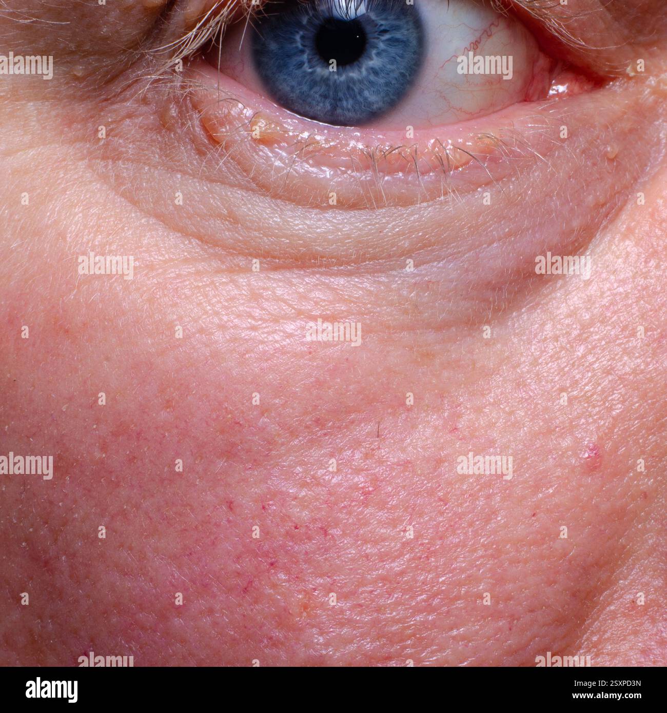 Papilloma on the human eye close-up Stock Photo - Alamy