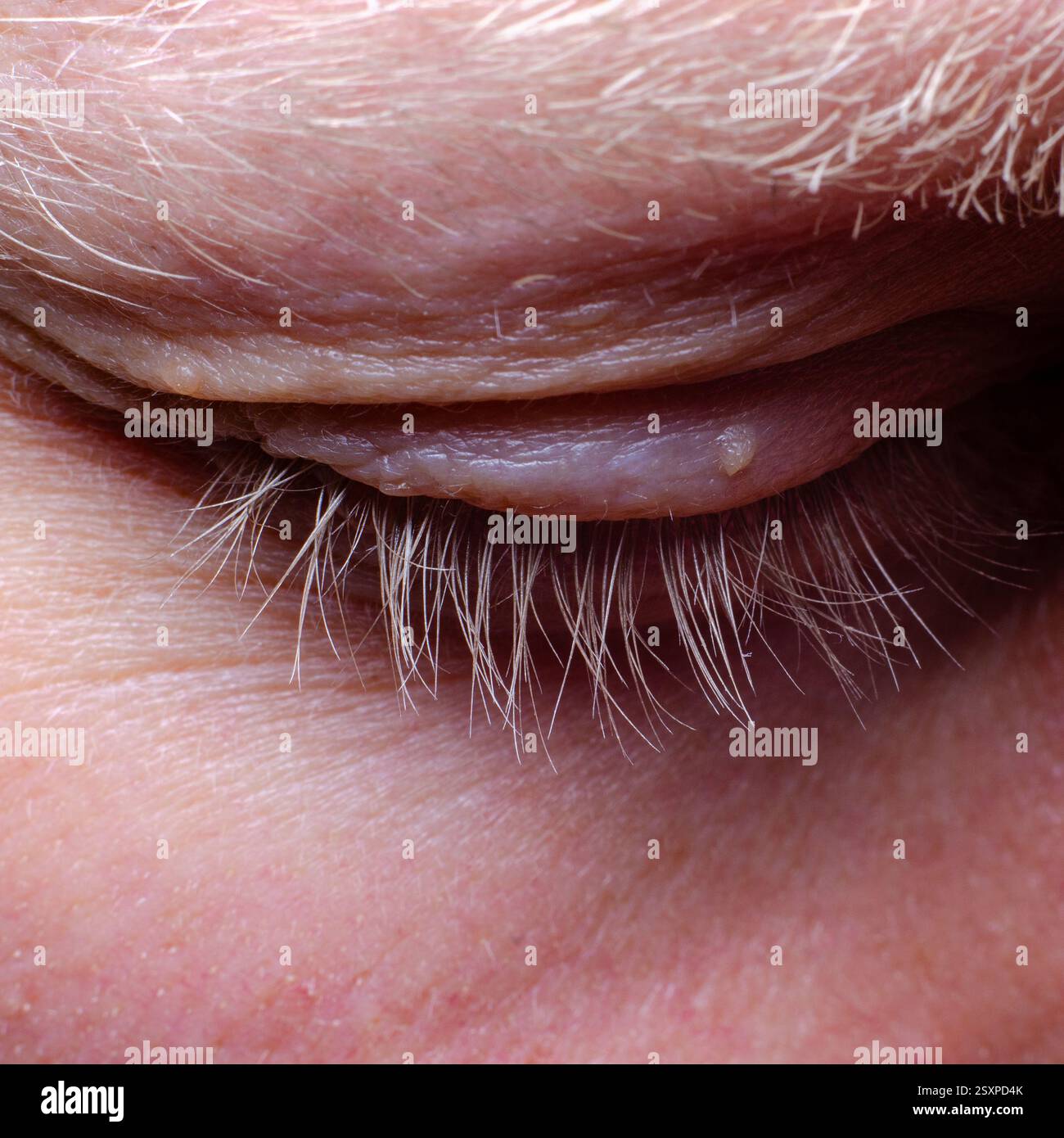 Basal cell papilloma hi-res stock photography and images - Alamy