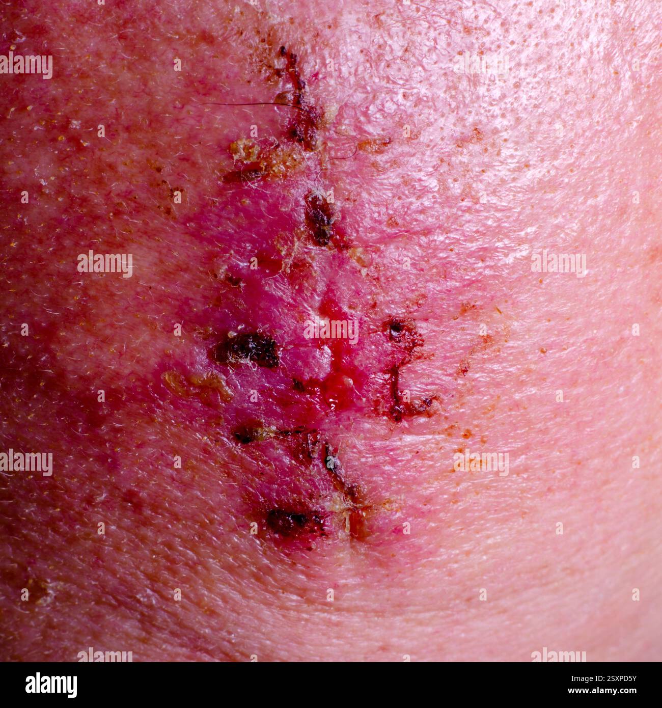 Wound after removal of stitches after skin cancer surgery Stock Photo - Alamy