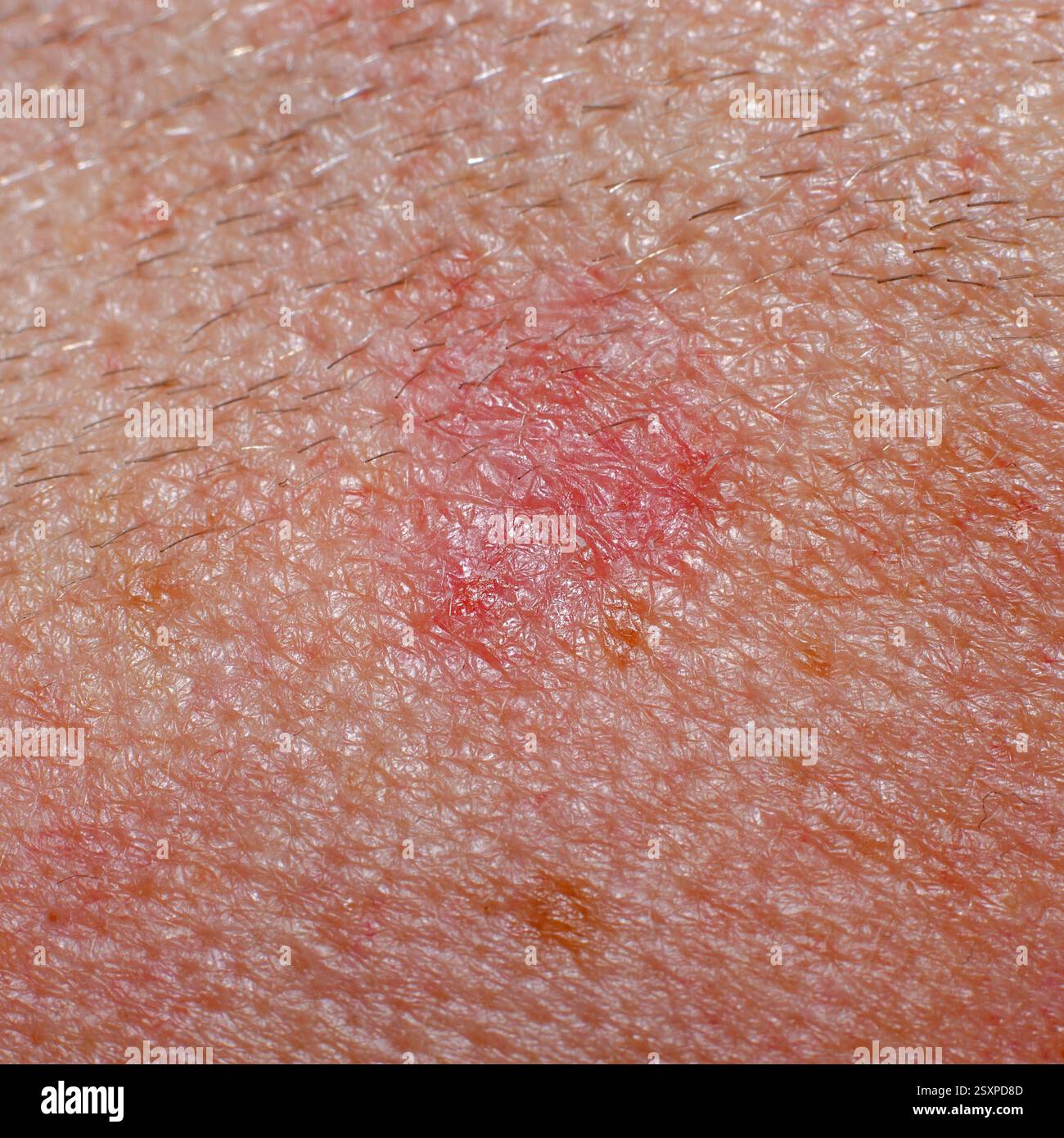 Solar keratosis or basalioma on human scalp Stock Photo - Alamy