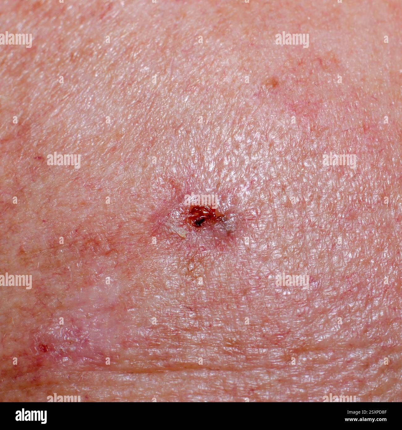 Solar keratosis or basalioma on human scalp Stock Photo - Alamy