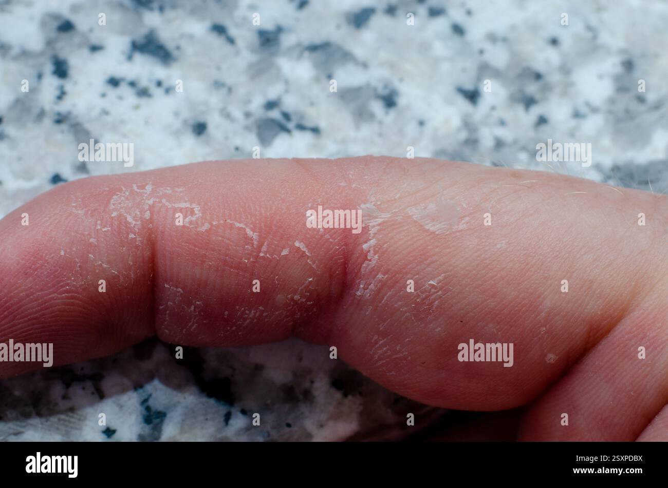 Alkali damage to human skin close-up Stock Photo - Alamy