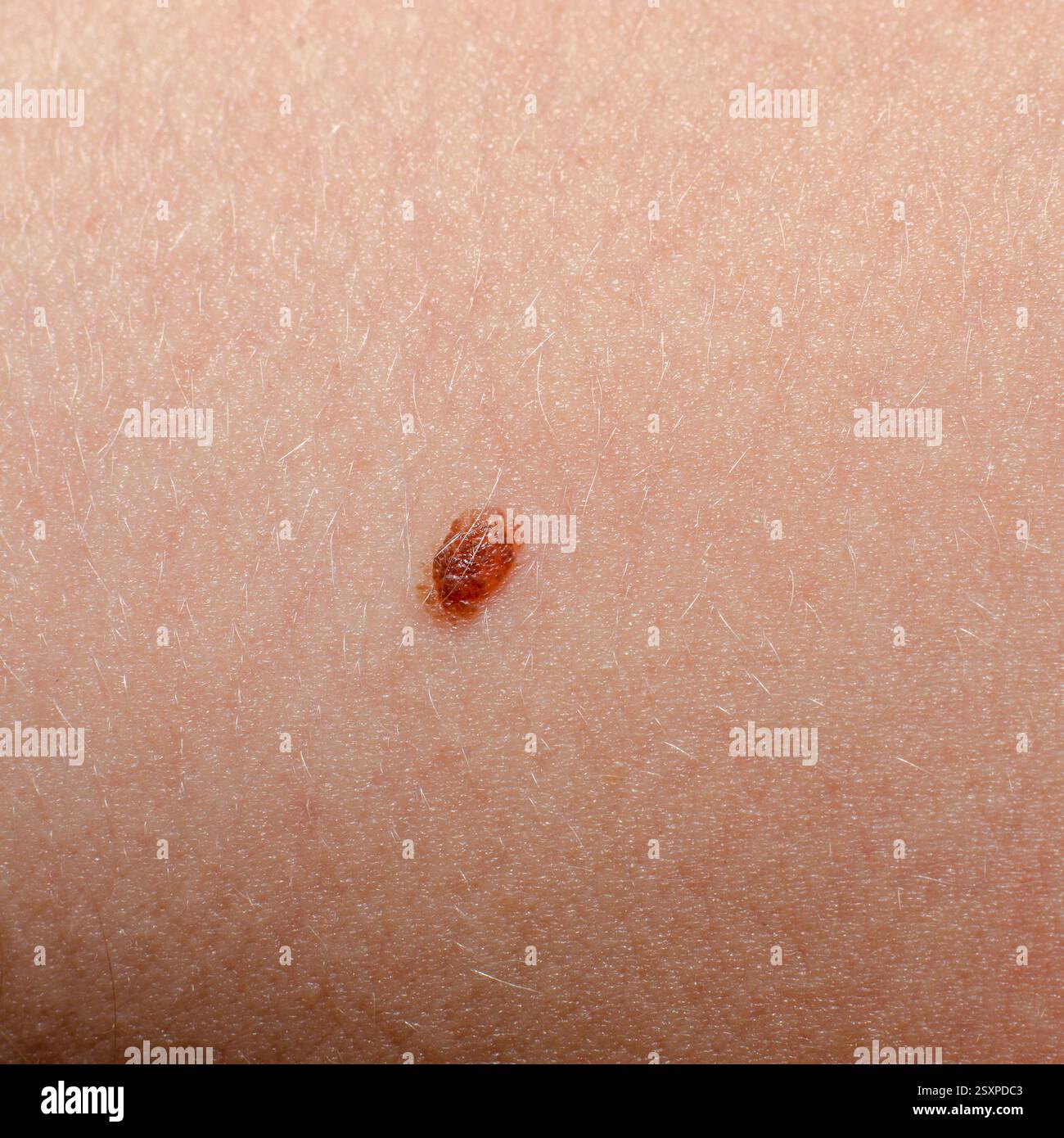 Nevus or mole on the human body close-up. Skin cancer, keratosis or ...