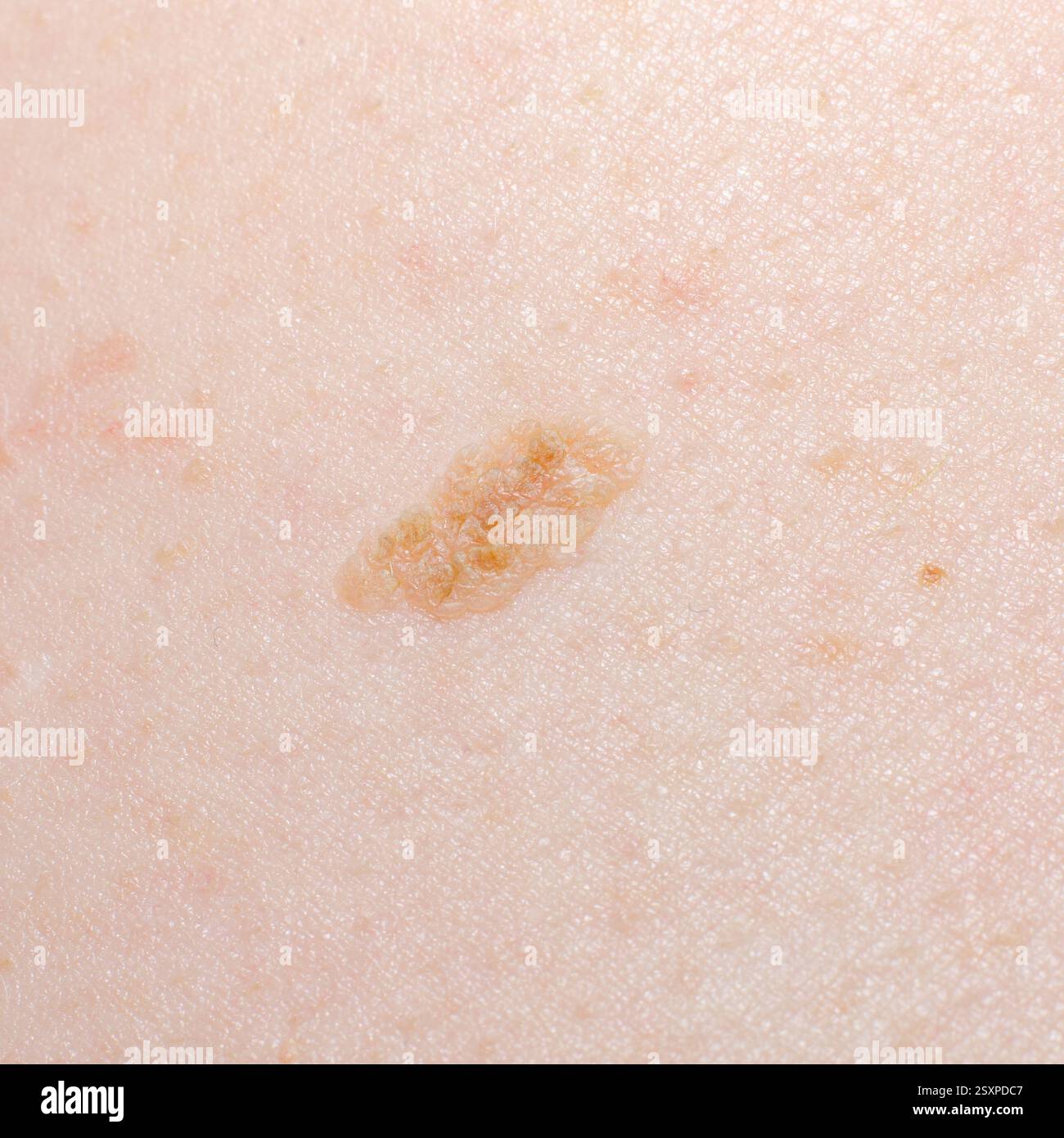 Nevus or mole on the human body close-up. Skin cancer, keratosis or ...