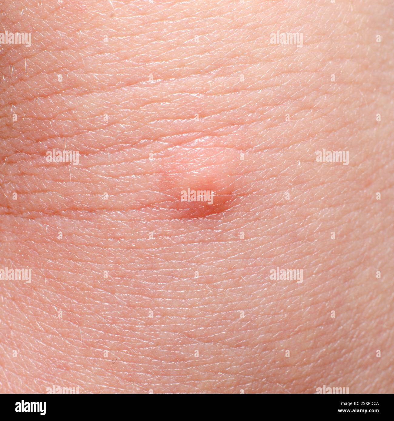 Nevus or mole on the skin of the human body close-up Stock Photo - Alamy