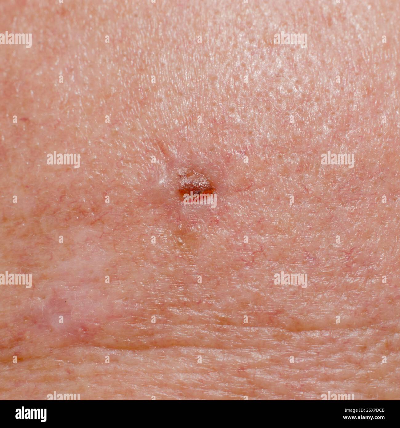 Nevus or mole on the human body close-up. Skin cancer, keratosis or ...