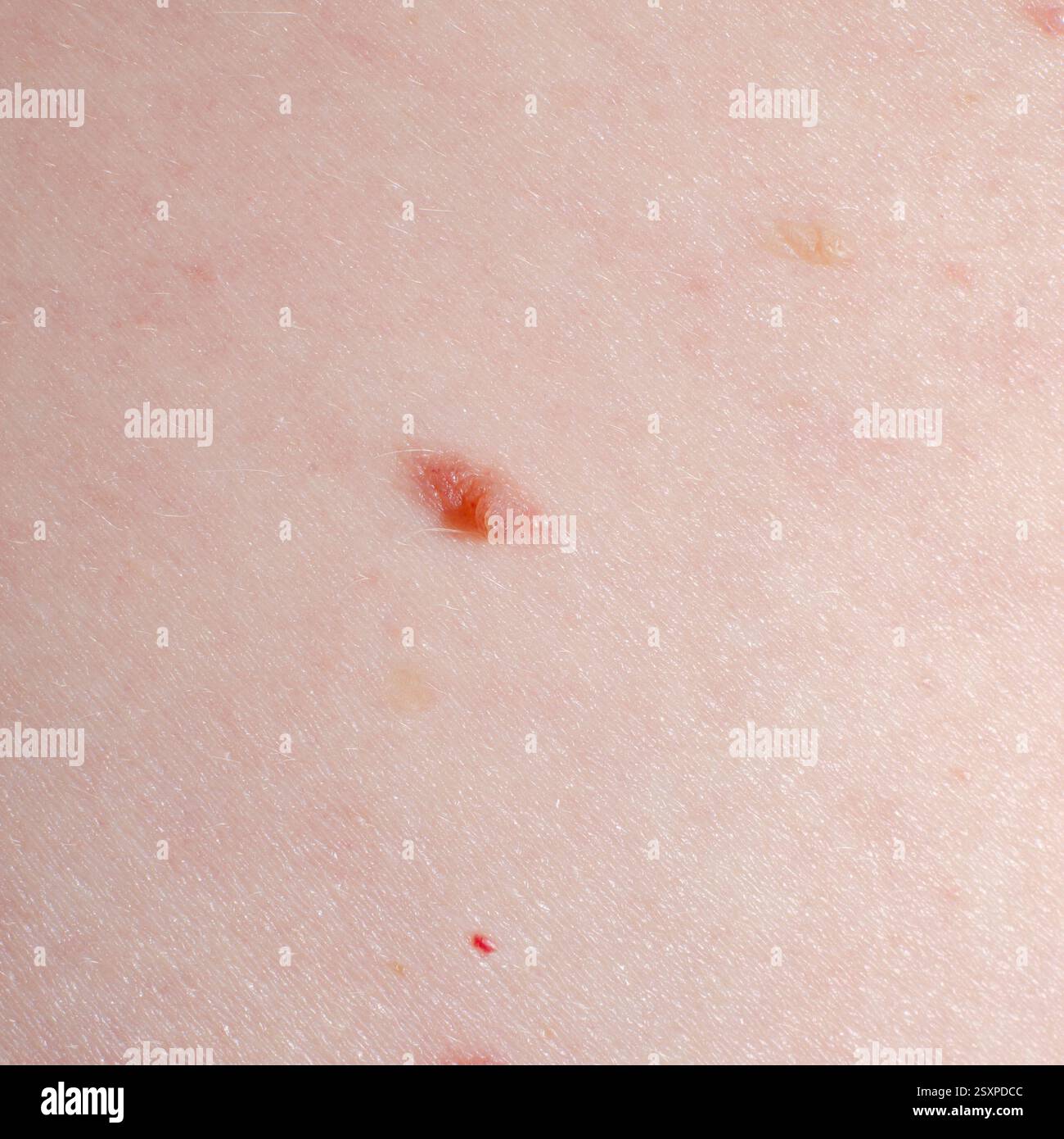 Nevus or mole on the skin of the human body close-up Stock Photo - Alamy
