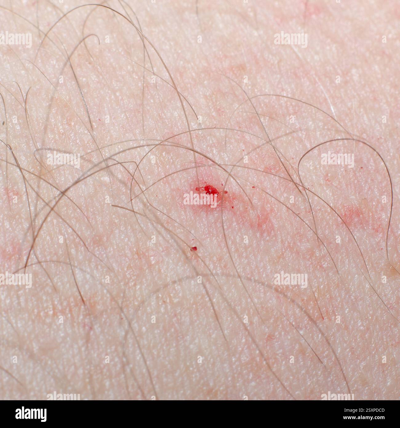 Nevus or mole on the human body close-up. Skin cancer, keratosis or ...