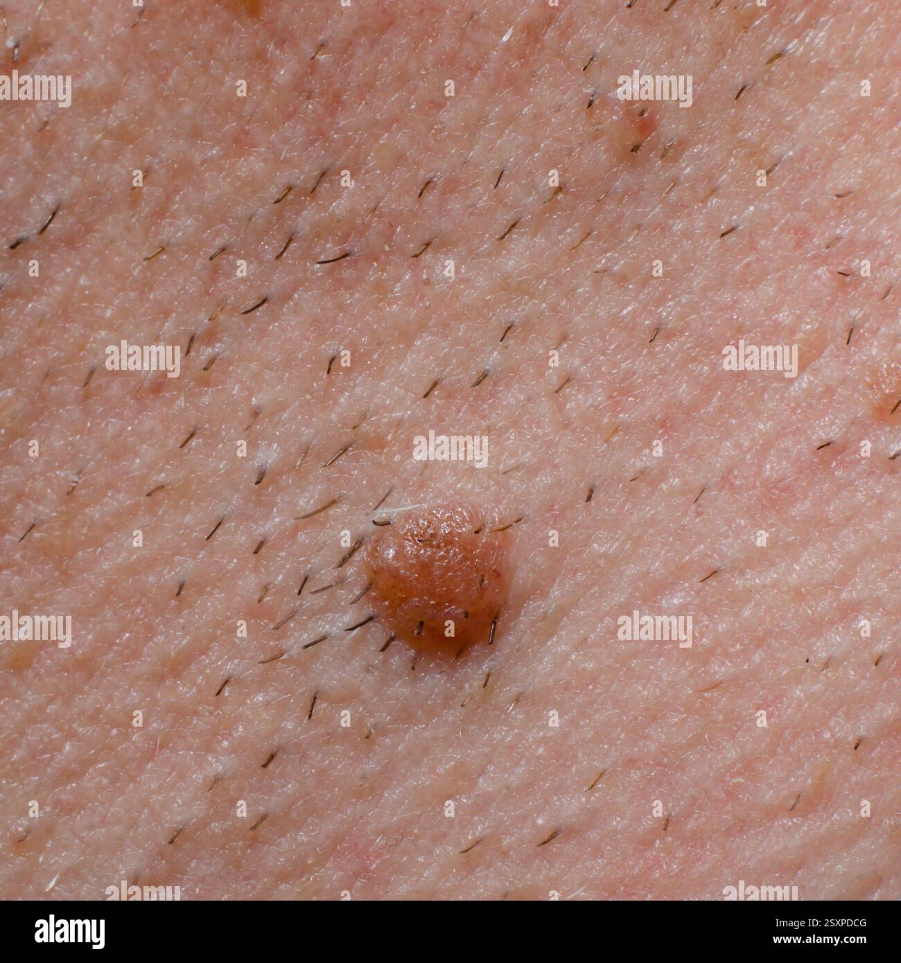 Nevus or mole on the skin of the human body close-up Stock Photo - Alamy