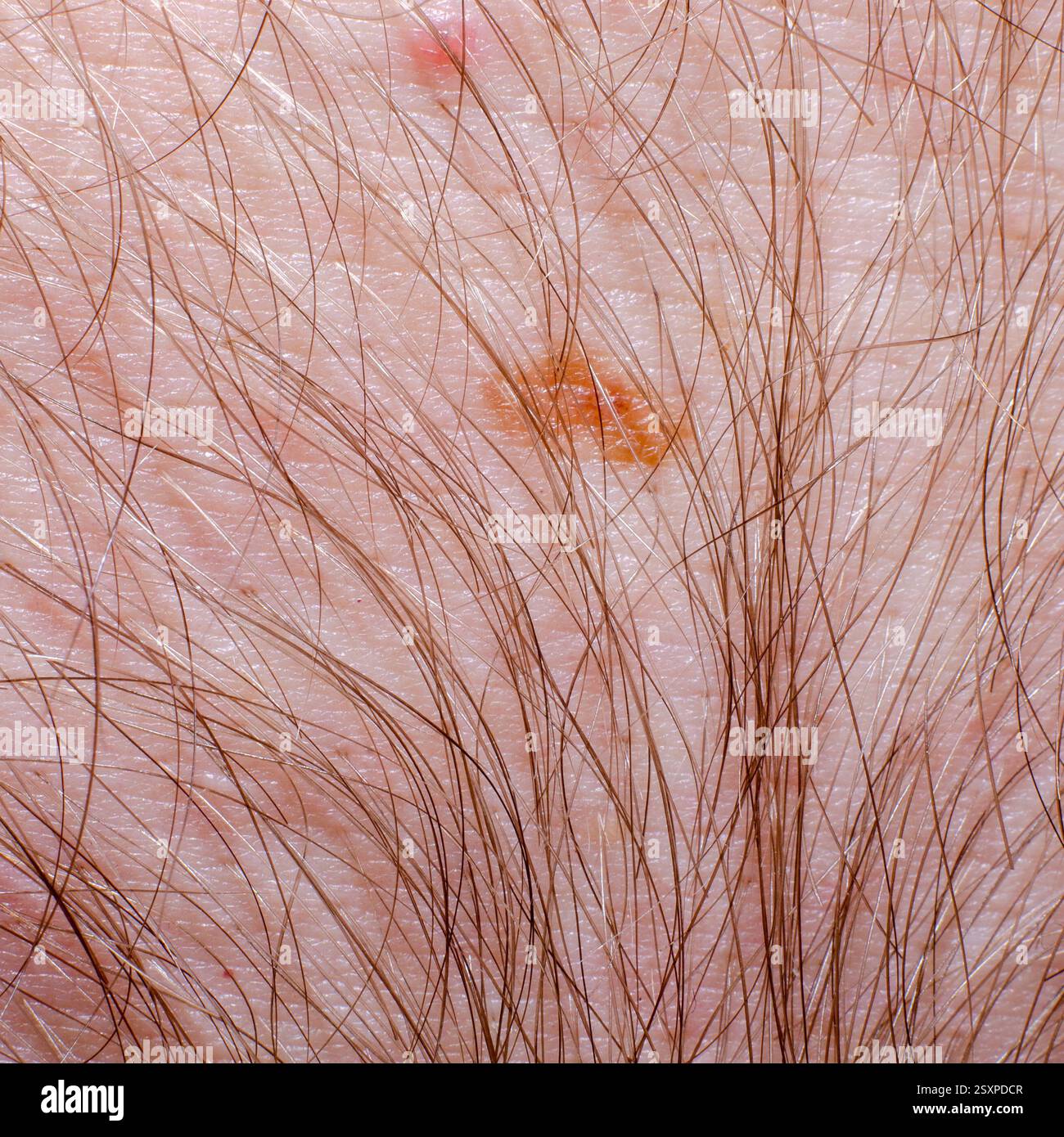 Nevus or mole on the human body close-up. Skin cancer, keratosis or ...