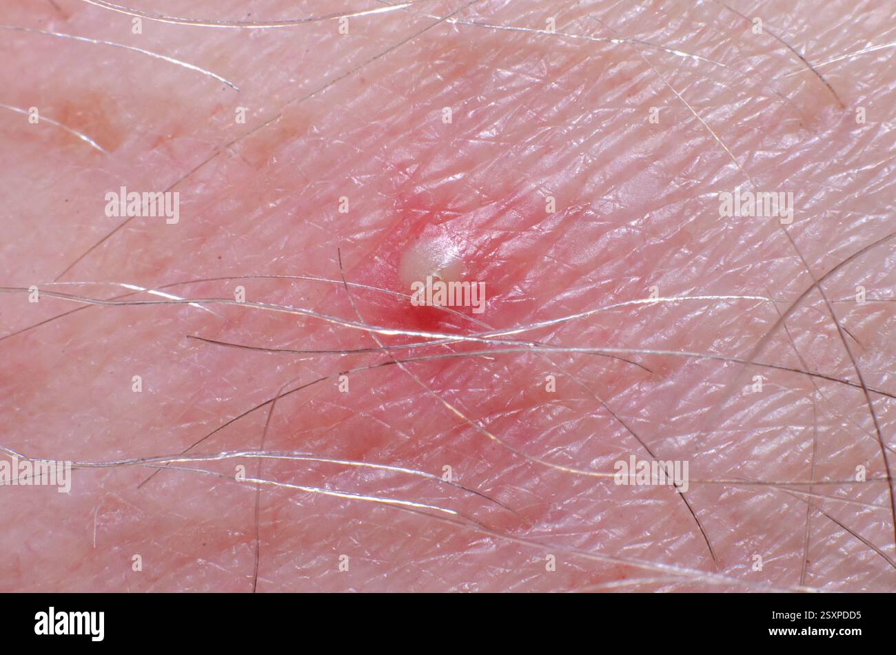 White pimple and hair growing from it. skin inflammation Stock Photo ...