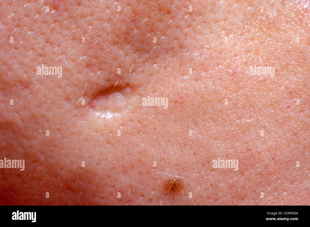 Scar after big pimple on human skin Stock Photo - Alamy