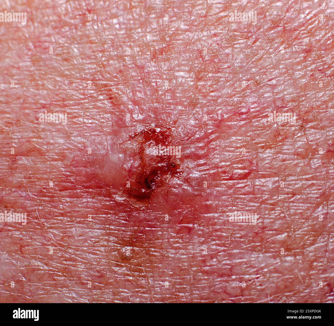 Cancer on the scalp. Non-healing skin wound Stock Photo - Alamy